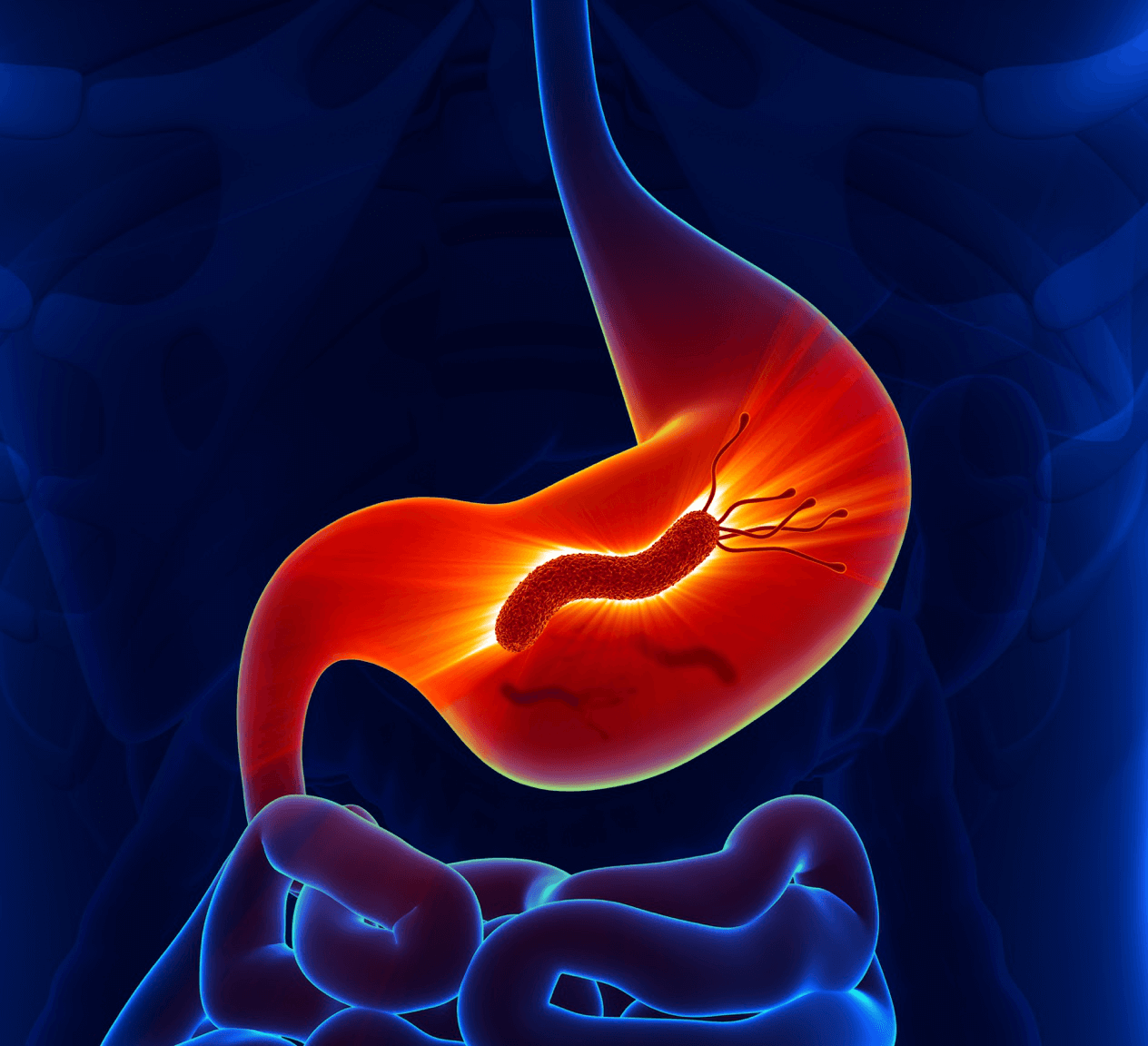 Peptic Ulcer Disease Causes Diagnosis And Treatment PGL Peptic Ulcer Disease Causes Diagnosis And Treatment PGL
